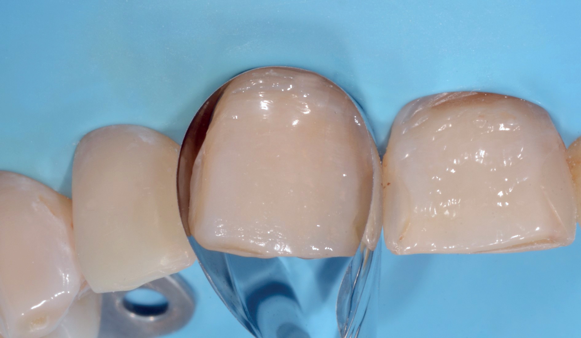 The Many Uses Of Polydentia Unica Anterior - Optident